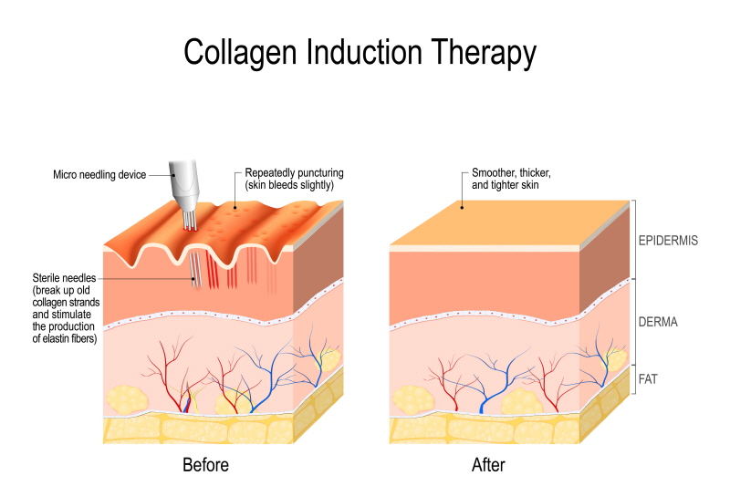 Pore Tightening Treatments | Dr. K Medi Spa Orange County